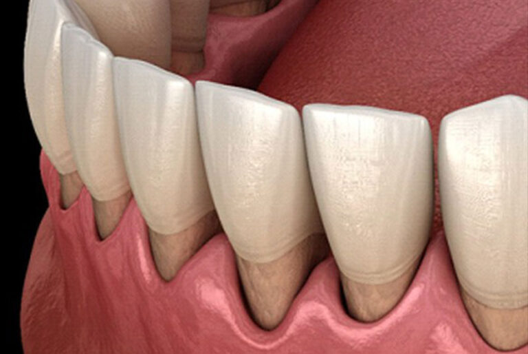 Bay Area Implants & Periodontics | Full Mouth Dental Implants | California