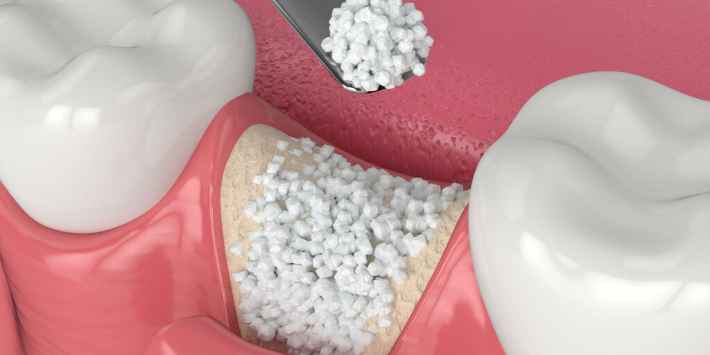 Receding Gums Treatment | San Jose, CA | Bay Area Implants & Periodontics